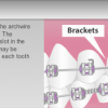 Parts of Braces | Gamache Orthodontics