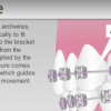 Parts of Braces | Gamache Orthodontics