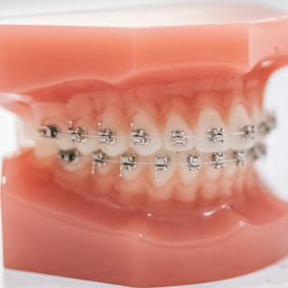 Types of Braces | Gamache Orthodontics